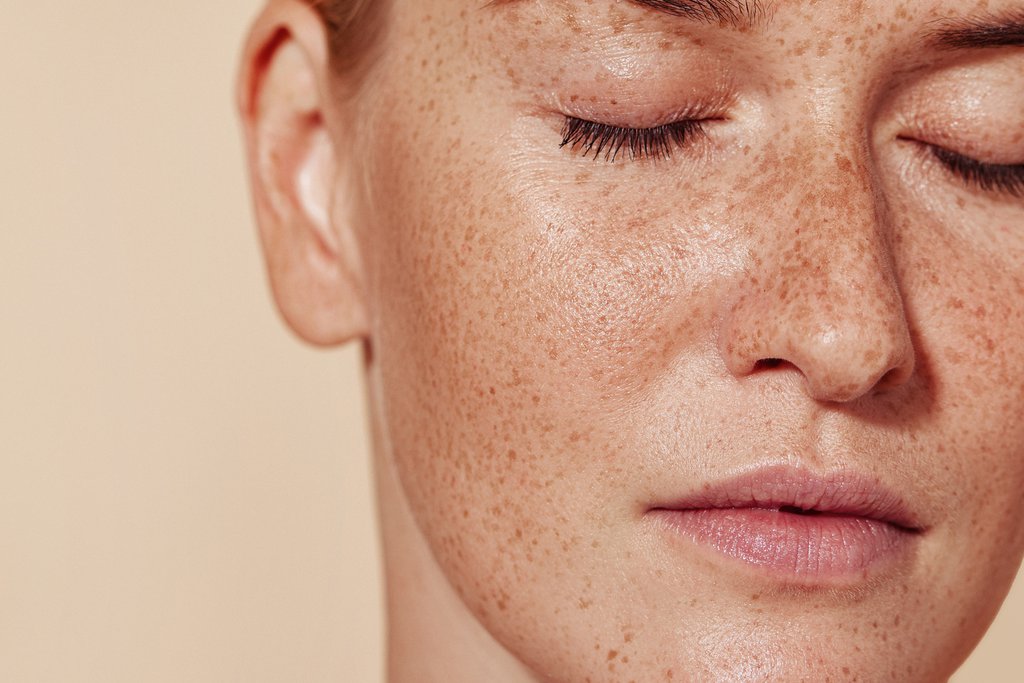 Moles, sunspots and freckles: What they are and when to be concerned ...